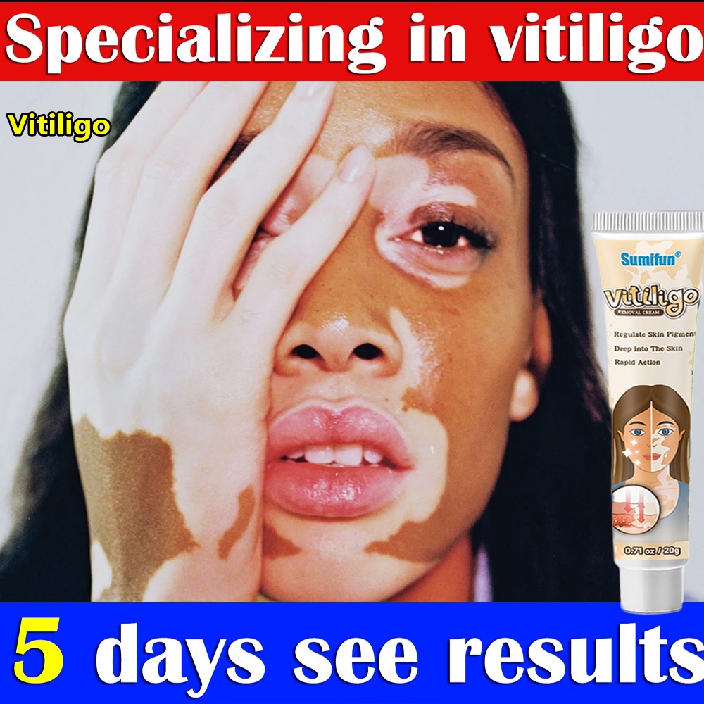 Jual Pengobatan Vitiligo obat vitiligo ampuh /protopic Vitiligo alep ...