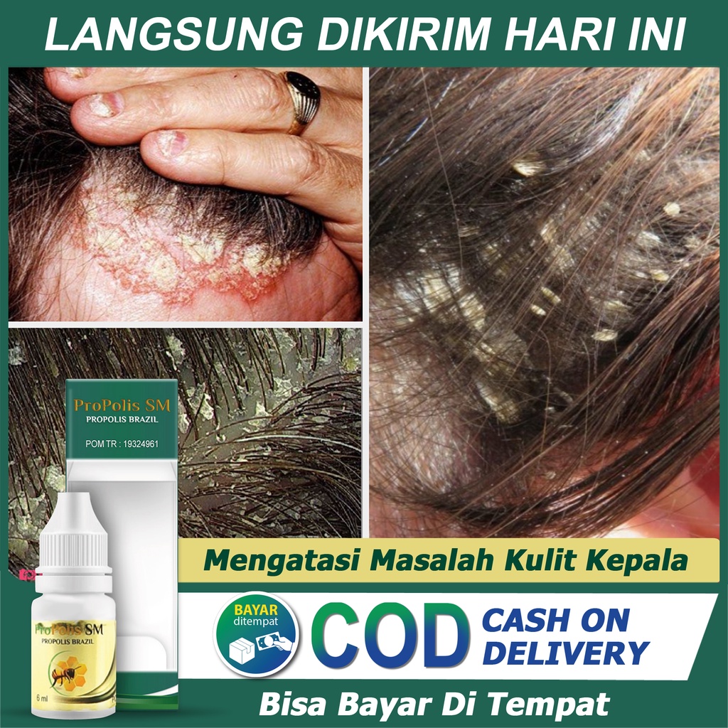 Jual Obat Kulit Kepala Berkerak - Ketombe Parah - Jamur Kulit Kepala - Kurap - Psoriasis - Borok ...