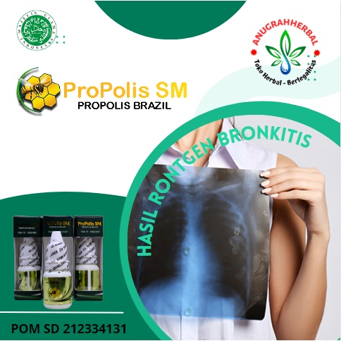 Jual Hasil rontgen bronkitis - Obat bronkopneumonia - infeksi paru ...