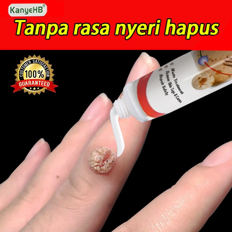 Jual [100% ORI] Wart Remover Cream penghilang kutil Repair And Clean ...