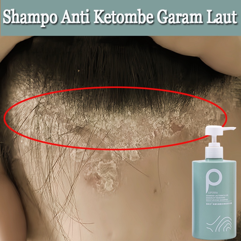 Jual Shampo buat ketombe Penghilang Ketombe Shampoo anti ketombe 500ML Ketombe Berkerak Jamur ...