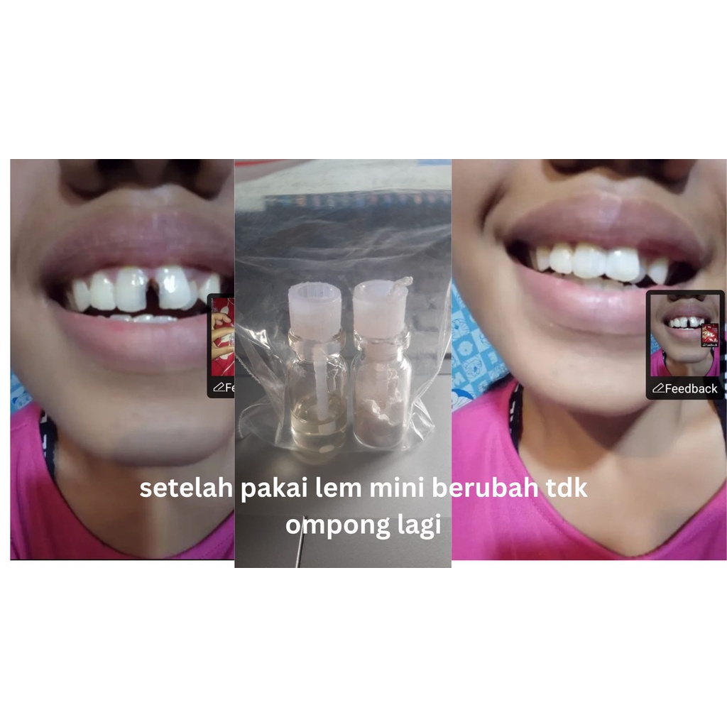 Jual Lem mini buat tambal gigi yang bolong atau merapatkan gigi ...