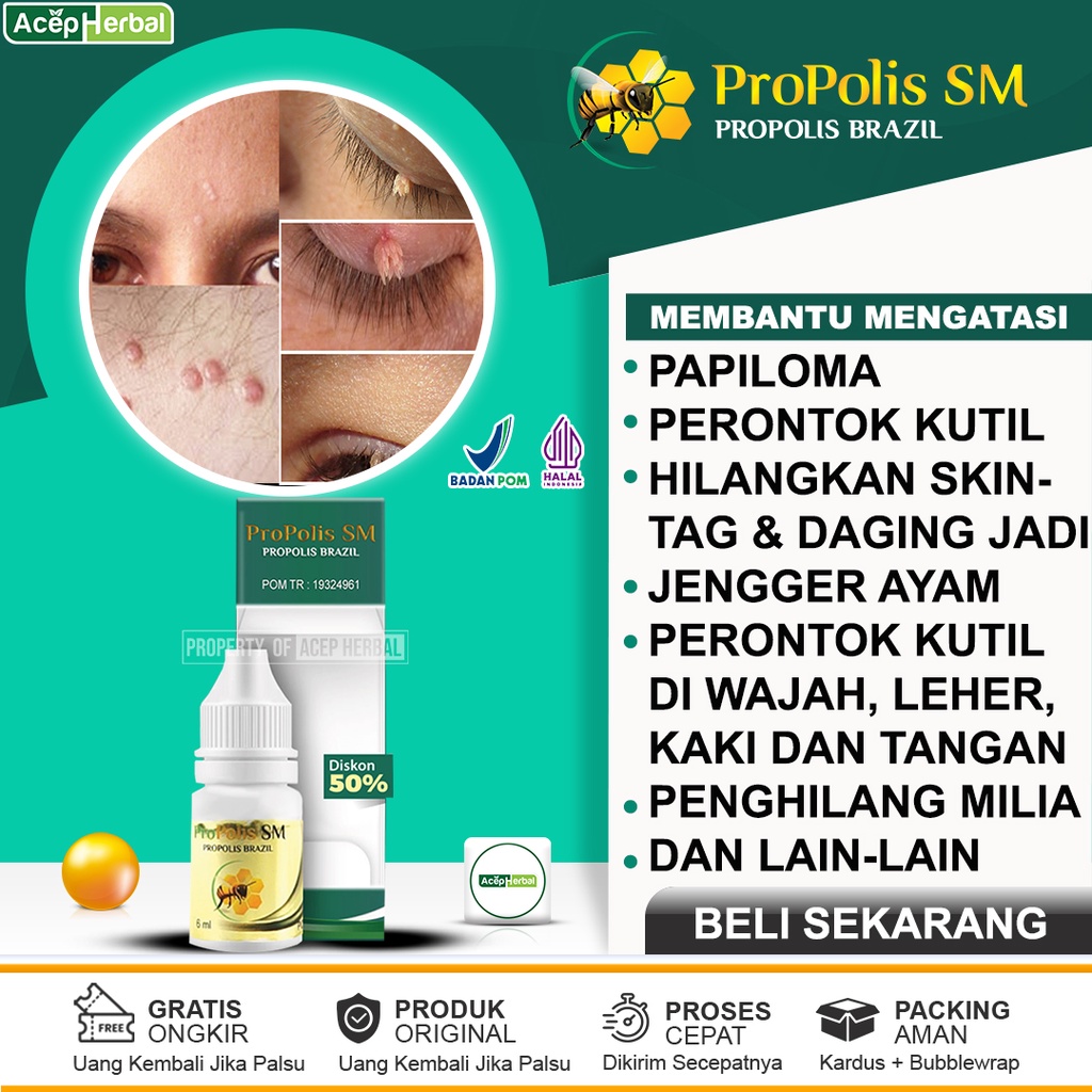 Jual Obat Kutil Di Leher Wajah Tangan Papiloma Perontok Kutil Daging ...