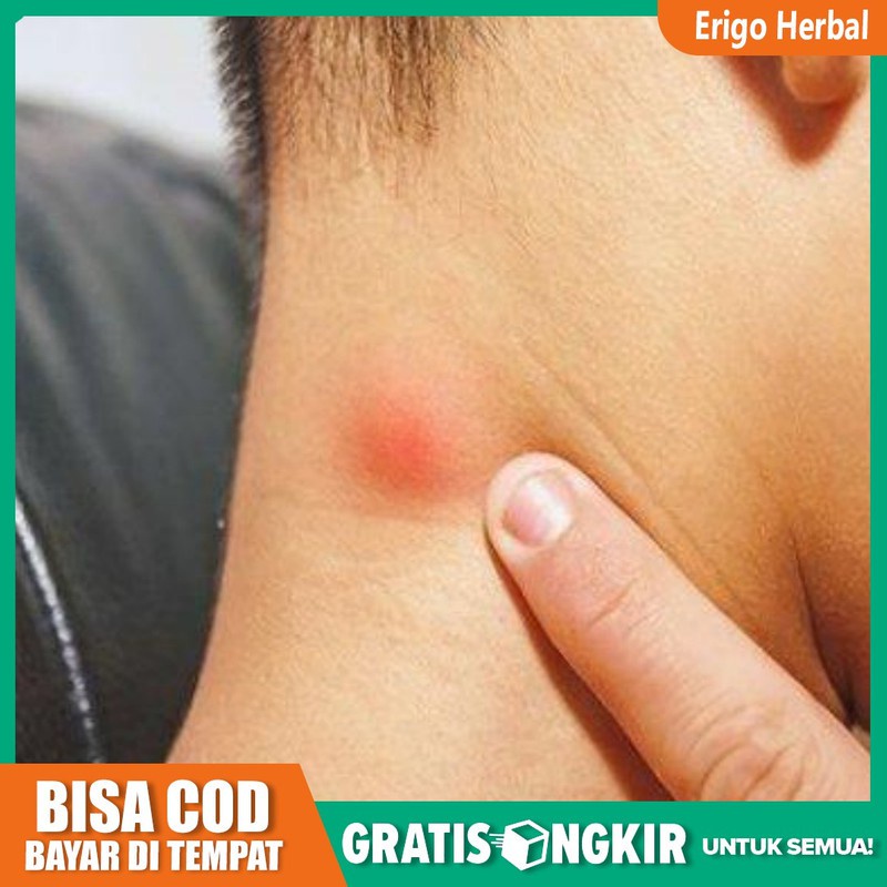 Jual Obat Benjolan Pada leher - Benjolan Di Leher - Kelenjar di Leher ...