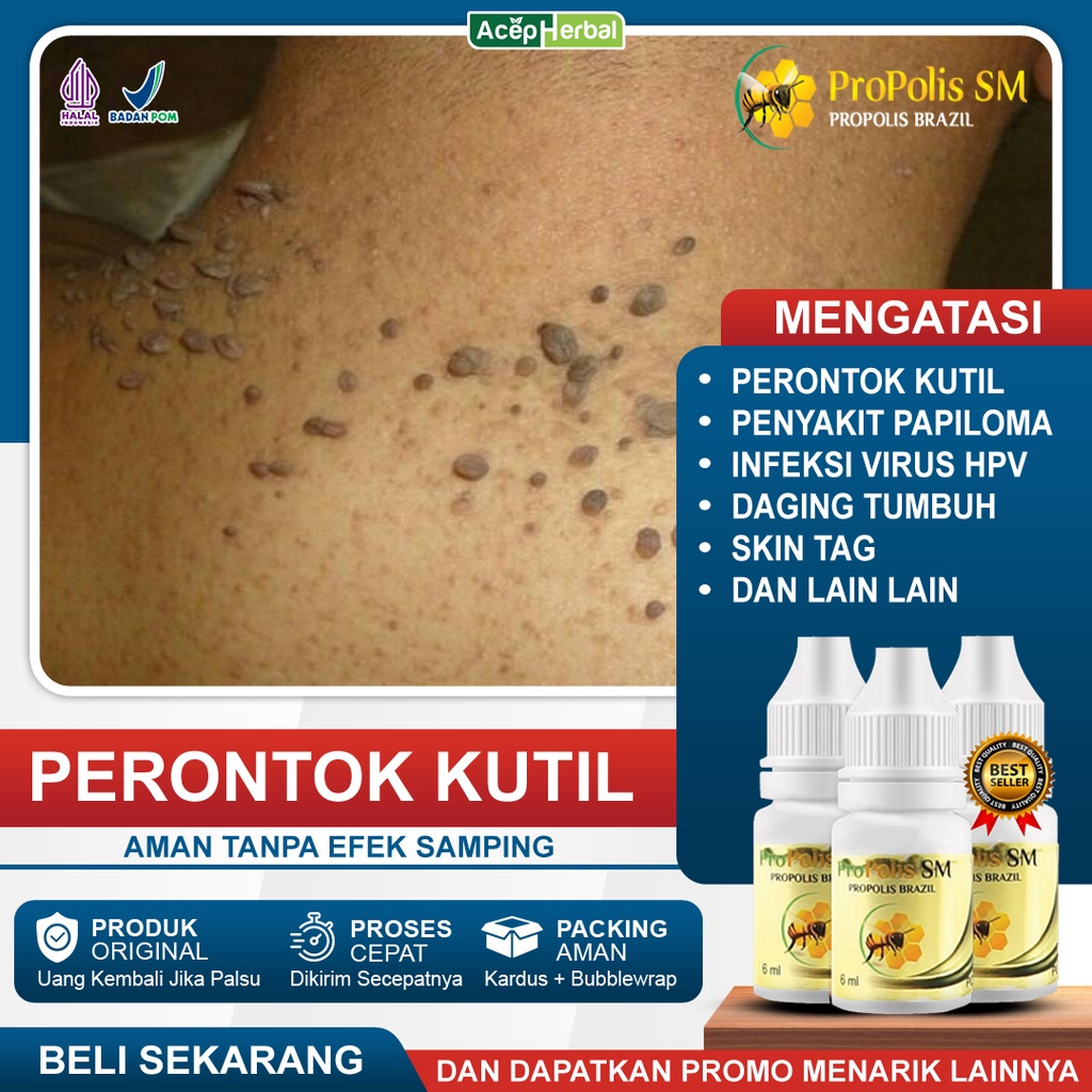 Jual Obat Kutil Kelamin Penghilang Skin Tag Daging Tumbuh Kutil Di ...