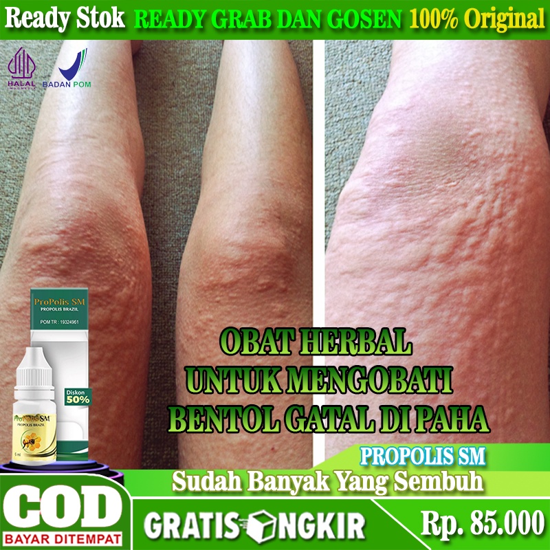 Jual Obat Bentol Gatal Di Paha, Gatal Di Paha Dan Bentol Merah Yang ...
