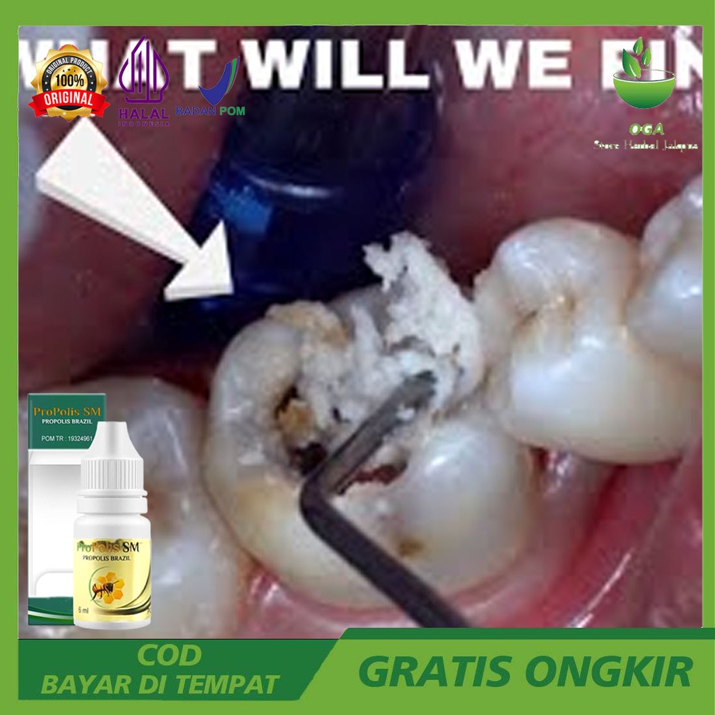 Jual Cara Menghilangkan Ulat Pada Gigi - Ulat Gigi Manusia - Ulat Gigi ...