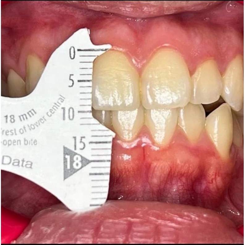 Jual Therabite TMJ ruler/penggaris TMJ/ whale ruler | Shopee Indonesia