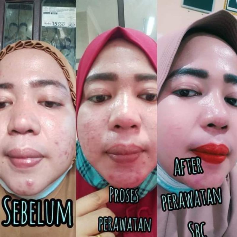 Jual SBC GLOWING PAKET GLOW UNTUK KULIT NORMAl,KUSAM,KERING | Shopee Indonesia