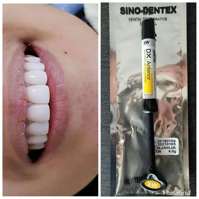 Jual DENTAL COMPOSITE DENTEX ANTERIOR XW/USE VENEER/TAMBALAN GIGI VENEER | Shopee Indonesia