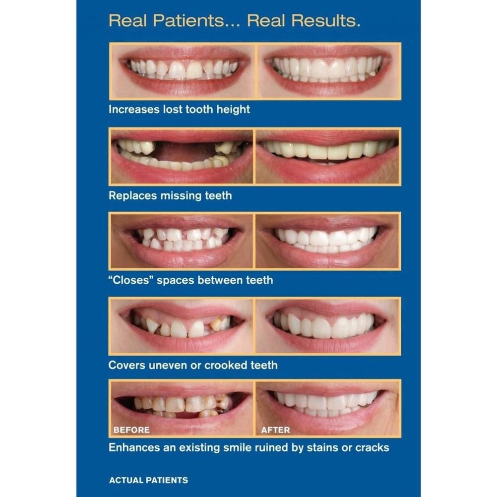 Jual SNAP ON SMILE 100% ORIGINAL AUTHENTIC GIGI PALSU 1 SET ATAS BAWAH ...