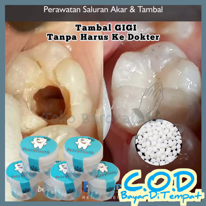 Jual 800 BUTIR TEMPTOOTH GIGI PALSU PENUTUP OMPONG PERMANEN LEM GIGI ...