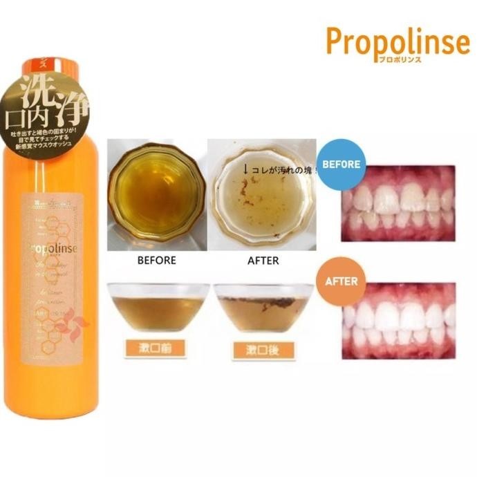 Jual Propolins Mouthwash 150Ml Obat Kumur Japan Obat Plak Karang Gigi ...