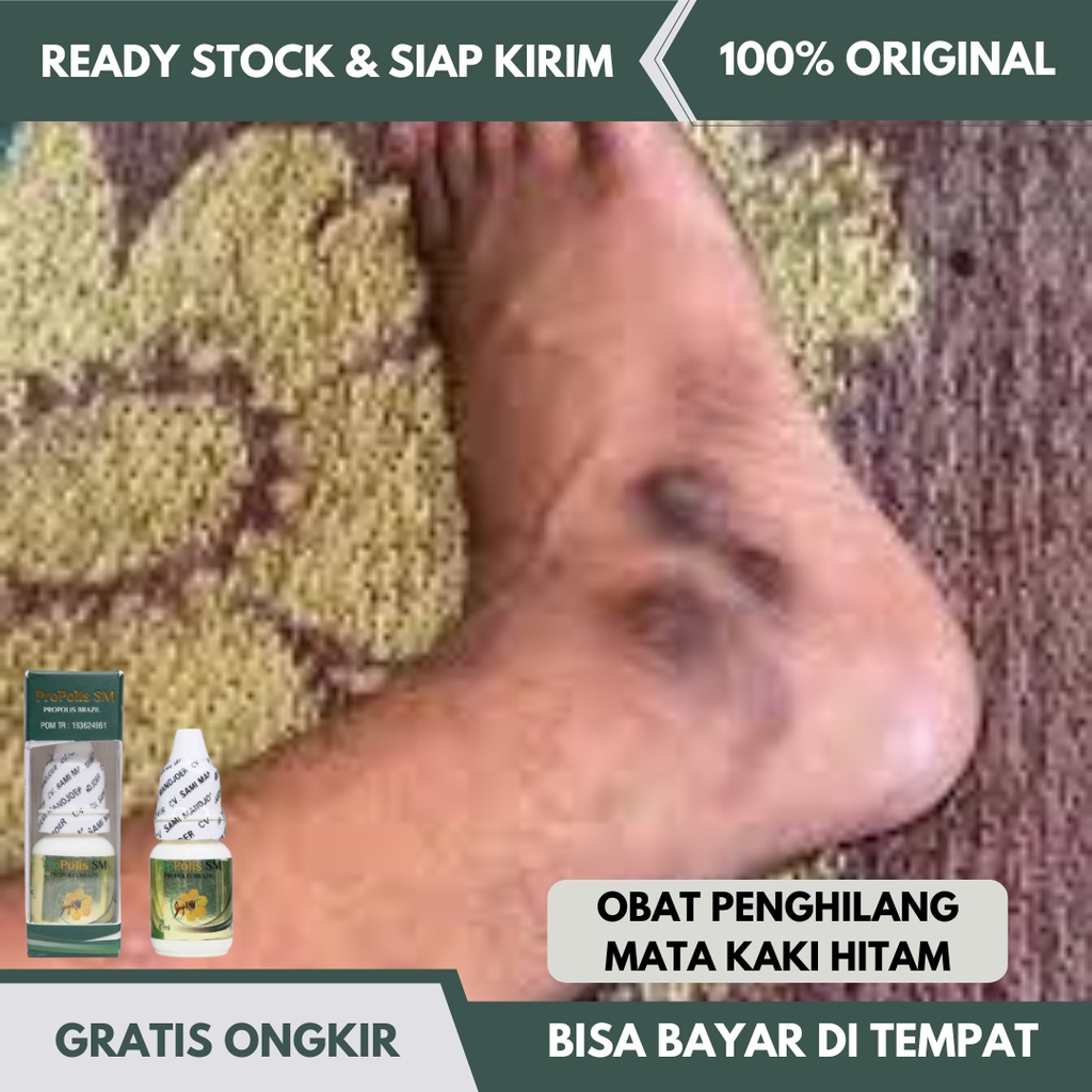 Jual Obat Oles Mata Kaki Hitam, Obat Pemutih Mata Kaki Hitam, Obat Mata ...
