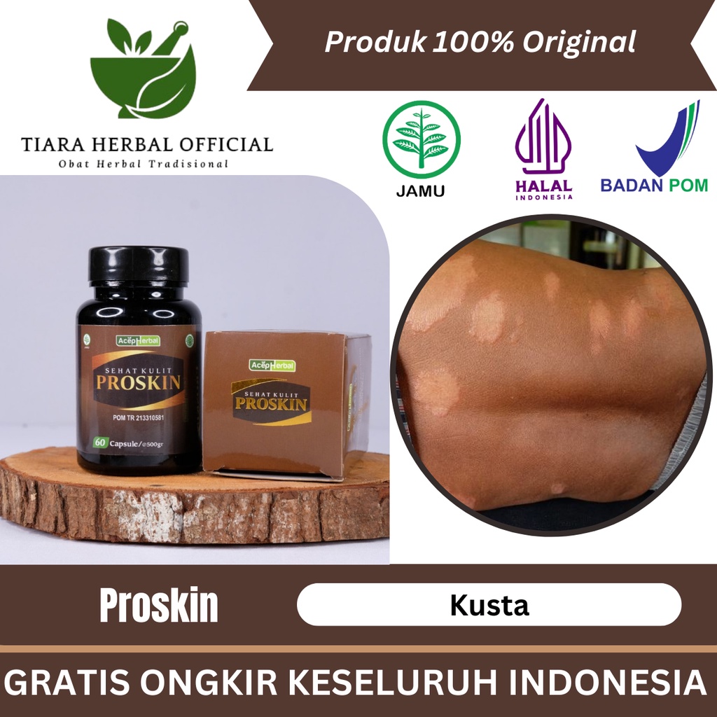 Jual Obat Kusta, Obat Kusta Kering Dan Basah, Lepra, Herbal Penyakit ...