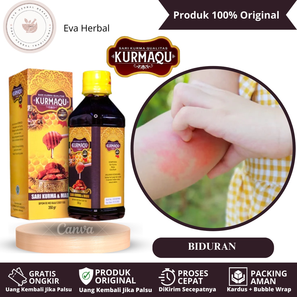 Jual Obat Gatal Biduran, Kaligata Menahun, Biduran Di Sekujur Tubuh ...