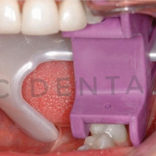 Jual TYU Dental Bite Blocker Tongue Blocker Penahan Gigi Lidah Rahang ...