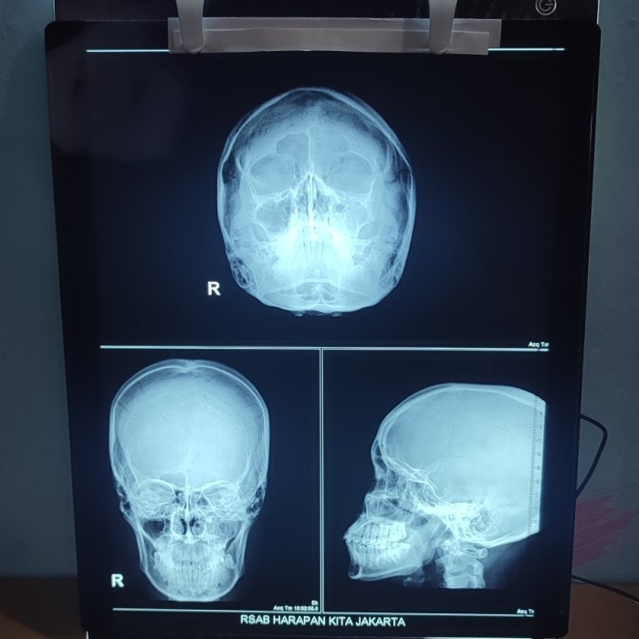 Jual Rontgen Film Viewer Led X-Ray Portable Uk A3 Slim | Shopee Indonesia