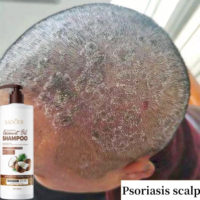 Jual shampoo anti ketombe Penghilang psoriasis dan ketombe berkerak Oil ...