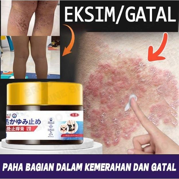 Jual Salap gatal kulit yang ampuh obat gatal selangkangan salep gatal ...