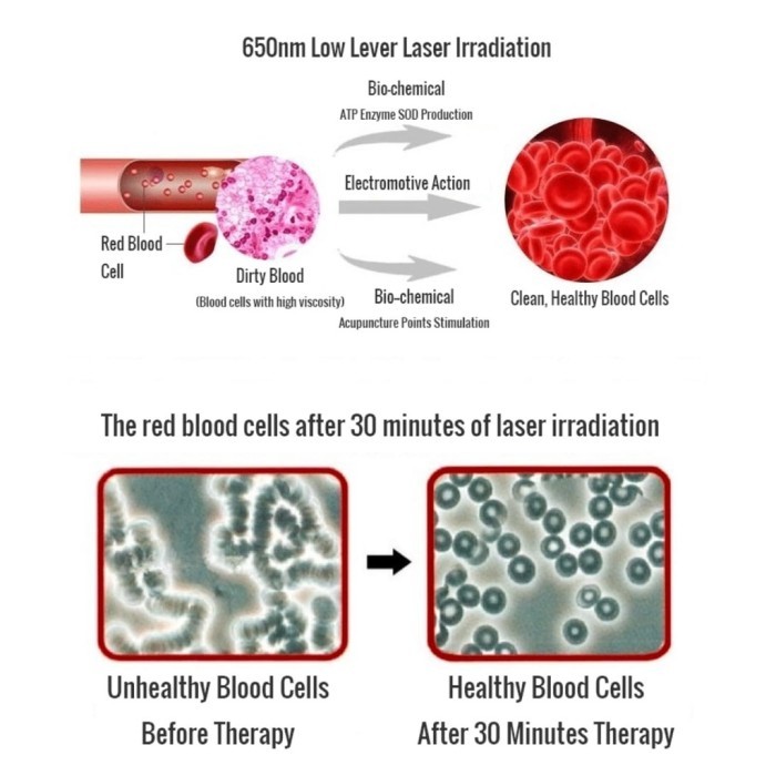 Jual Jam Laser Terapi 12 / 15 Titik Fisioterapi Semikonduktor | Shopee ...