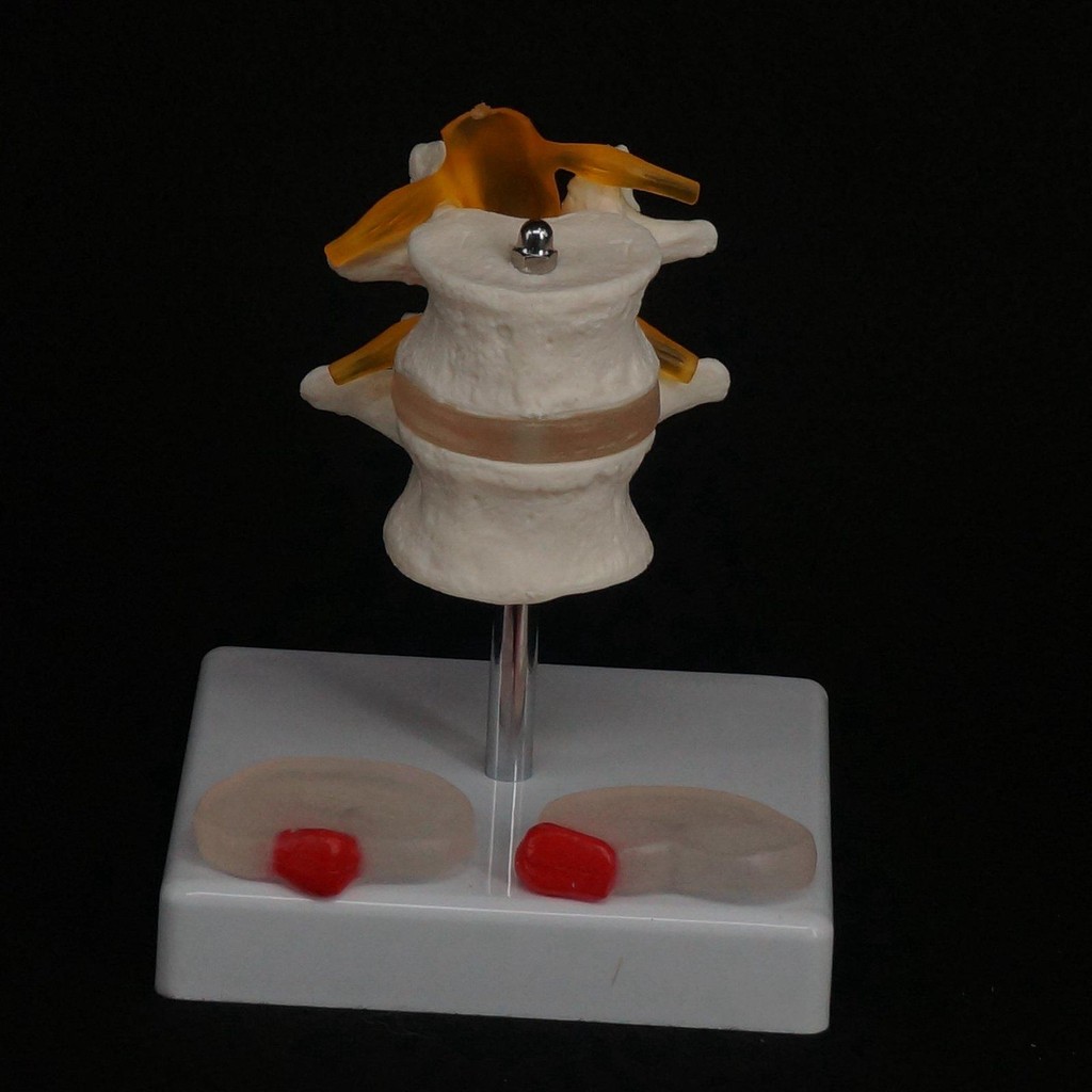 Jual Human Two Lumbar Lesions Intervertebral Disc Skeleton Spine Model ...