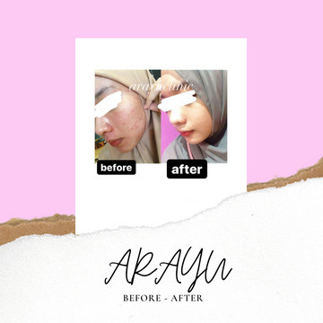 Jual Arayu Facial Wash for Acne Prone Skin 60gr | Shopee Indonesia