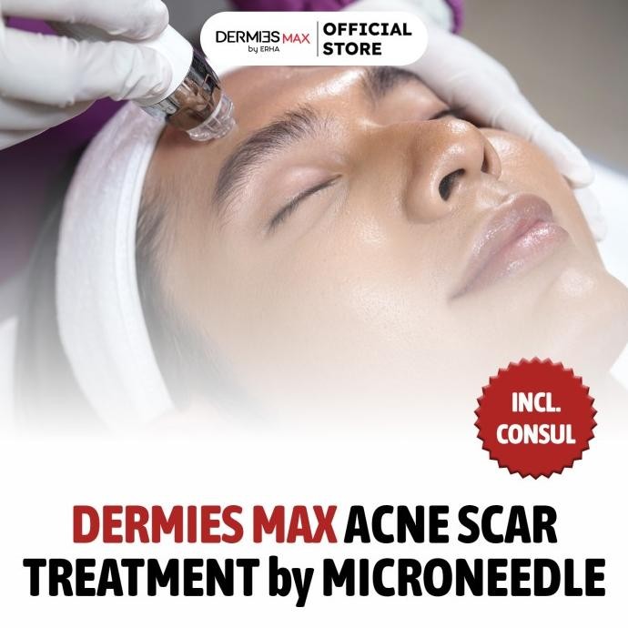 Jual Max Acne S Treatment by Microneedle | Shopee Indonesia