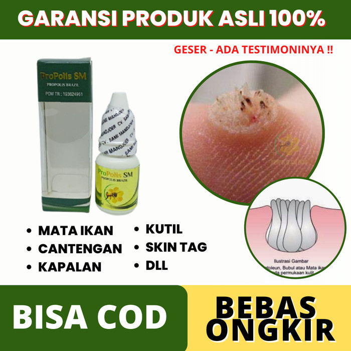 Jual CUCI GUDANG Obat Penghilang Mata Ikan Bengkak Di Telapak Kaki ...