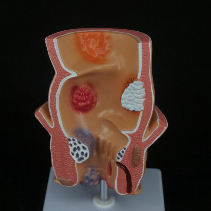 Jual ANATOMICAL HUMAN RECTUM PATHOLOGY LESION MODEL HEMORRHOIDS ANUS MEDICAL TEACHING RECTAL ...