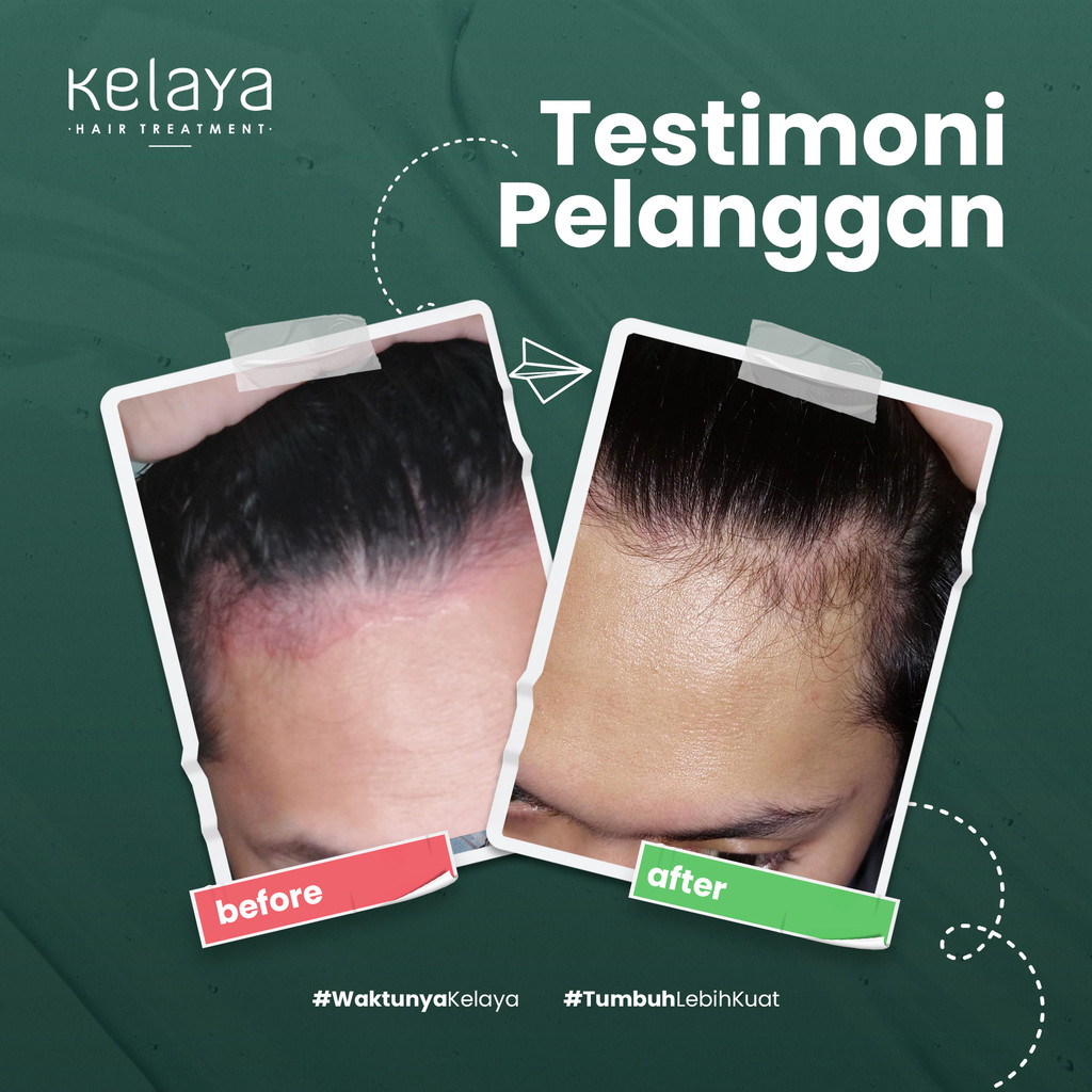 Jual Kelaya Serum Rambut 100ml Hair Treatment - Penumbuh Rambut Rontok ...