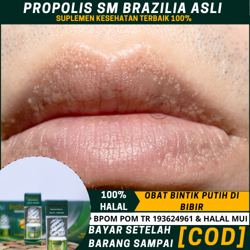 Jual Obat Bintik Putih Di Bibir, Obat Penghilang Bintik Putih Di Bibir ...