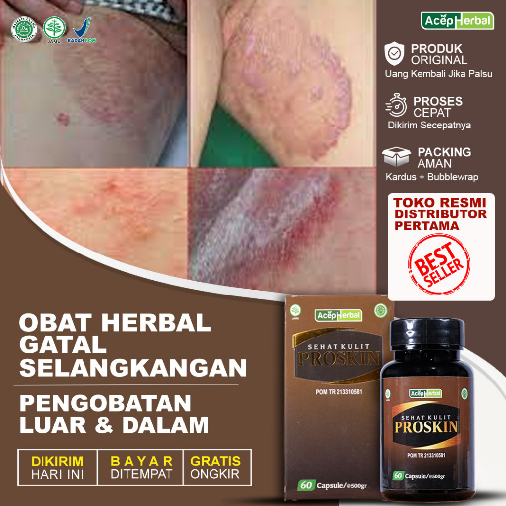 Jual Obat Gatal Selangkangan Proskin Original | Shopee Indonesia