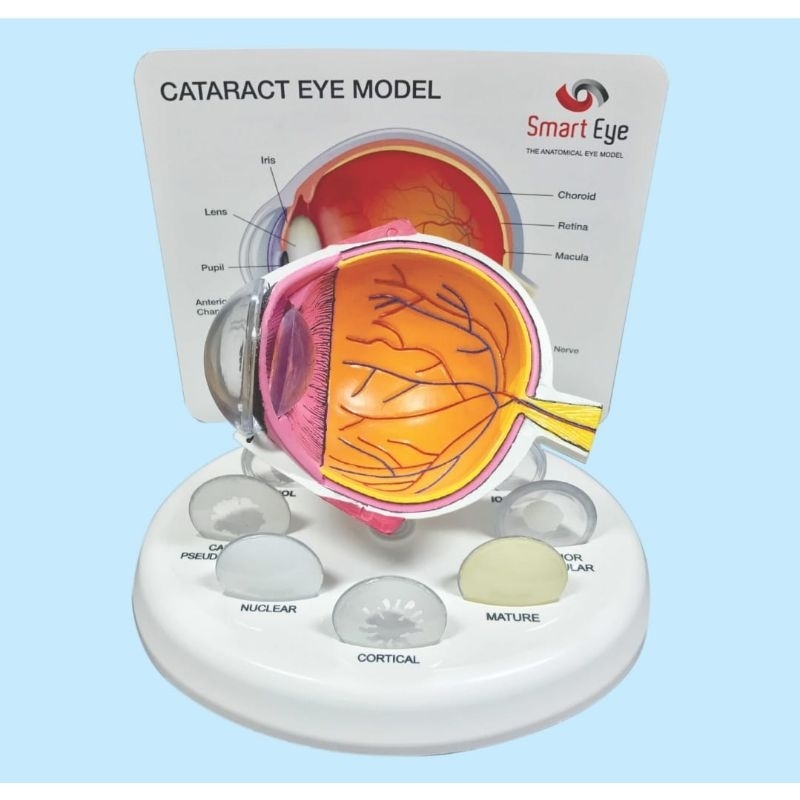 Jual Cataract Eye Model Anatomy - Model Mata Katarak - Anatomi Katarak ...