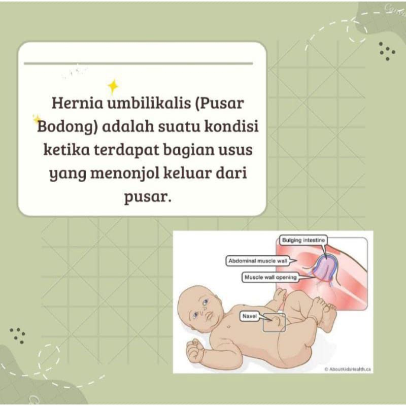 Jual Sabuk Hernia Bayi (Pusar Bodong) | Shopee Indonesia