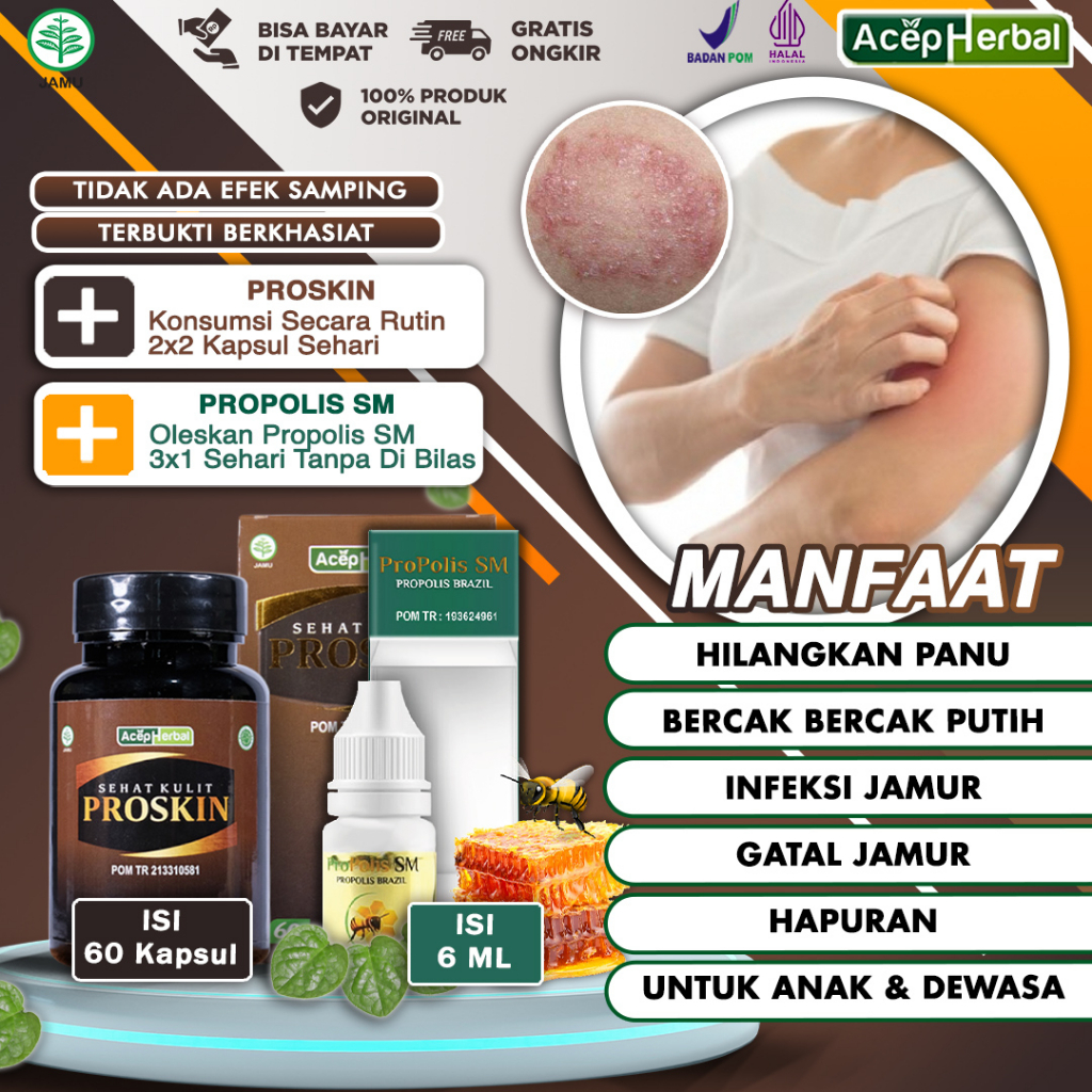 Jual Obat Panu Paling Alami untuk Penghilang Bercak Putih di Kulit ...