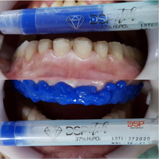 Jual AFHAM DENTAL ETCHING GEL GIGI DSP ETCH REGISTRASI AKL / ETSA ETCHA ...