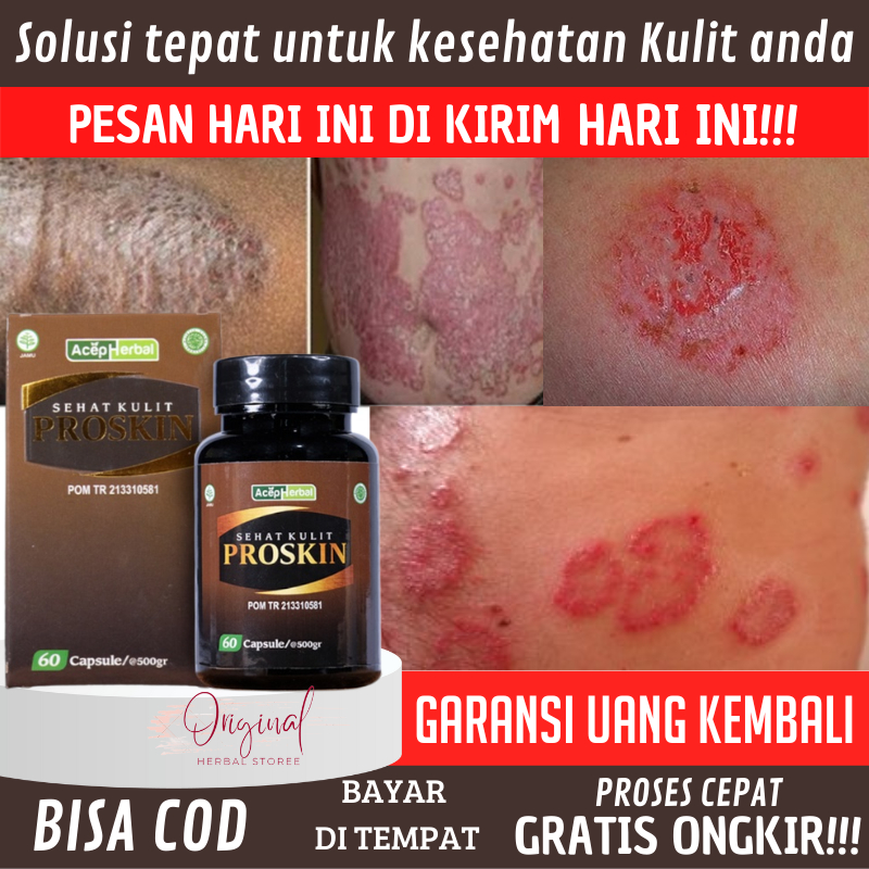 Jual Obat Eksim kering dan basah, Salep eksim basah, Obat eksim, Obat ...