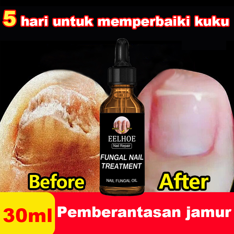 Jual obat jamur kuku Perawatan Kuku Berjamur dan Rusak untuk Kuku ...