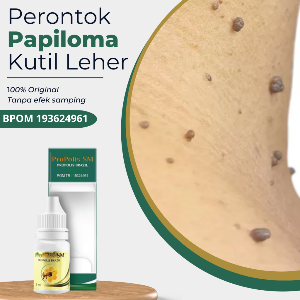 Jual Propolis SM - Obat Kutil di leher, Penghilang Papiloma leher ...