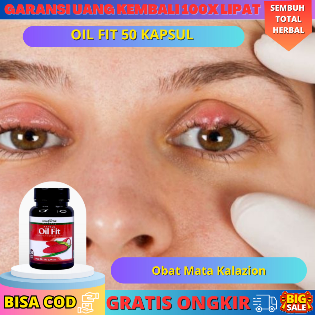 Jual Obat Mata Kalazion Timbilan Bintitan Benjolan Dekat Mata Oil Fit ...