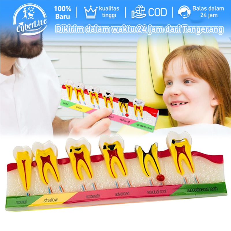 Jual Model Gigi Dental Periodontal Disease Model Dental Caries ... Jual Model Gigi Dental Periodontal Disease Model Dental Caries ...