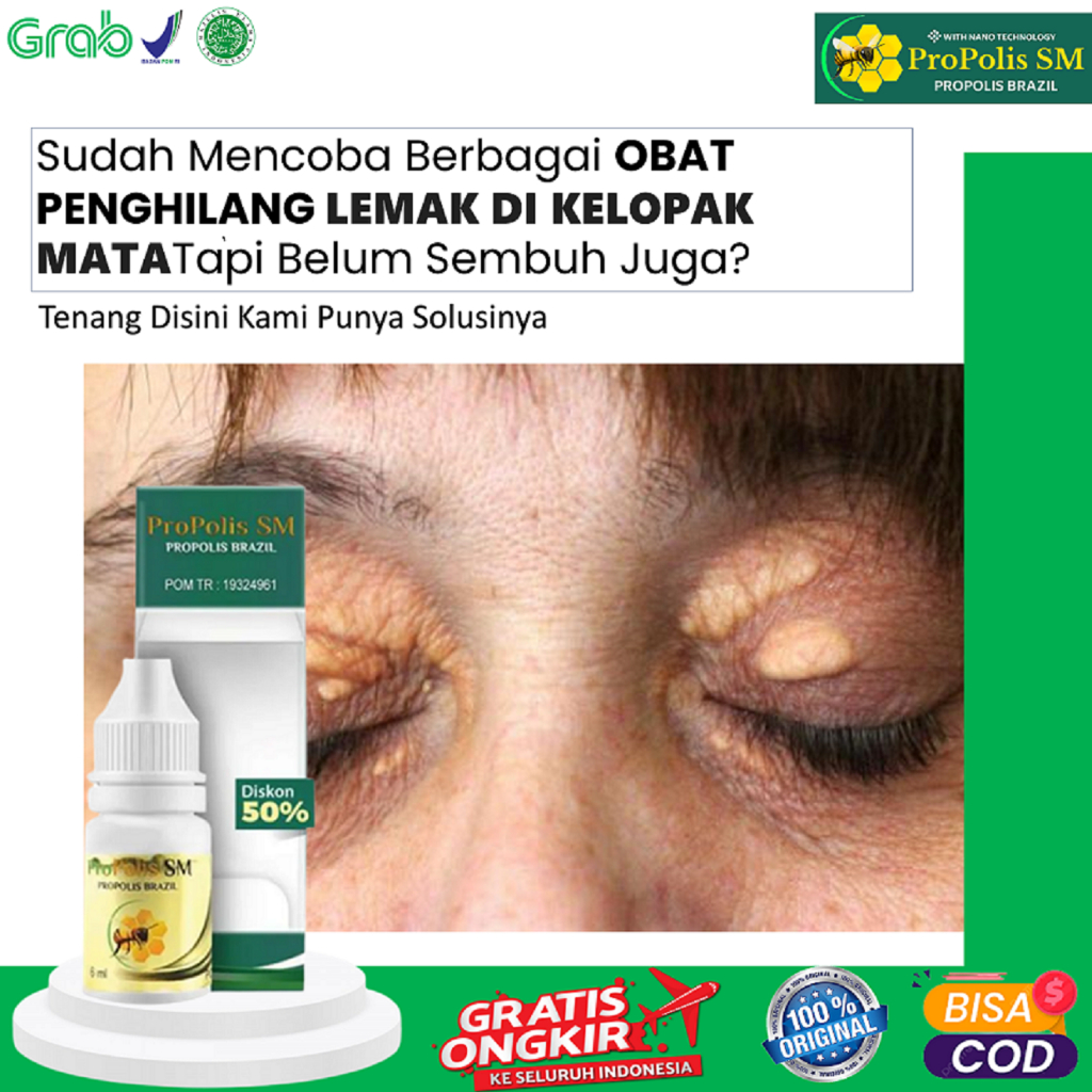 Jual Obat Penghilang Gumpalan Lemak Di Kelopak Mata Xanthelasma ...
