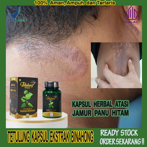 Jual Obat Penghilang Jamur Panu, Bercak Hitam/Panu Yang Menghitam ...