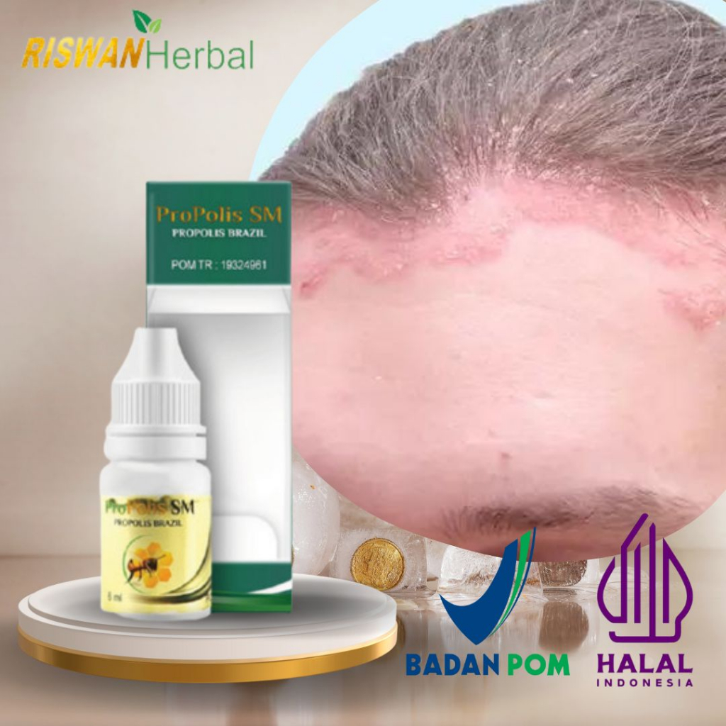Jual Obat Salep/Oles Psoriasis Kulit Kepala Kering Berkerak Bersisik Jamur Bersisik Ketombe ...