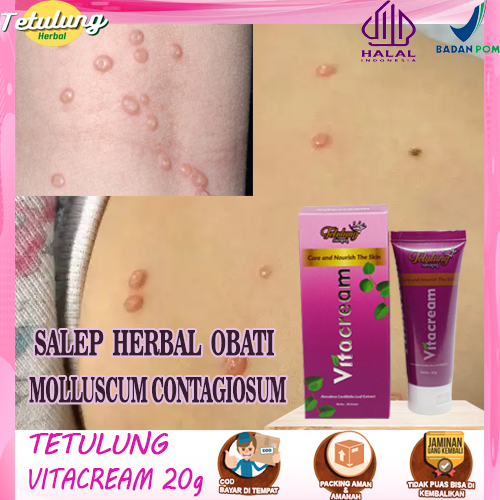 Jual Obat Moluskum Kontagiosum,Obat Bintil Bintil di Kulit Vitacream ...