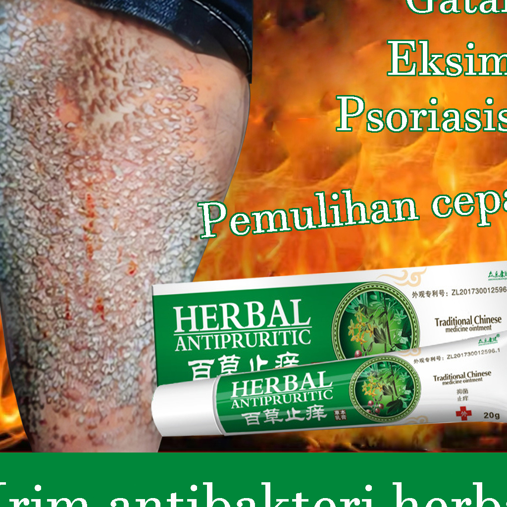 Jual 【100% ORIGINAL】Salep kulit psoriasis Salep gatal Salep Eksim Salep ...
