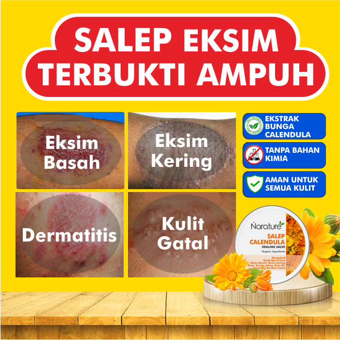 Jual Salep Obat Eksim Calendula Salve Kering Basah Menahun Paling Ampuh ...