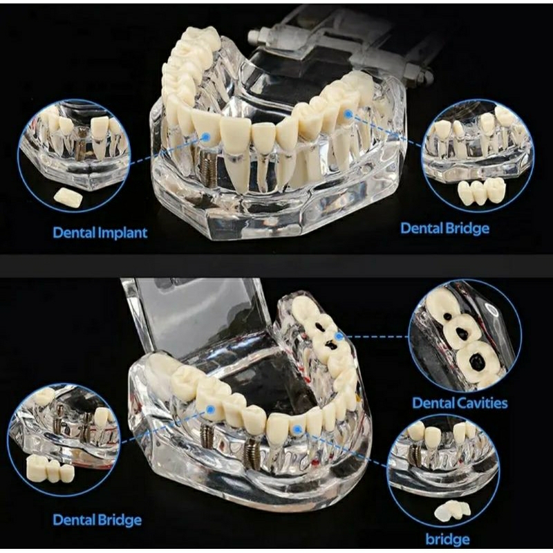 Jual Dental Model gigi Study transparan Crown bridge caries implan ...