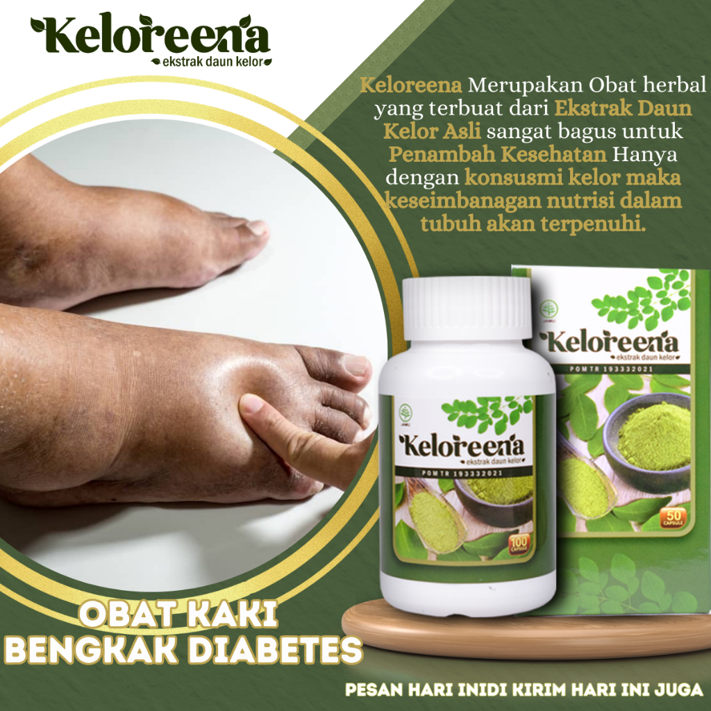 Jual Obat Kaki Bengkak karena Gula / Diabetes, Obat Asam Urat, Obat ... Jual Obat Kaki Bengkak karena Gula / Diabetes, Obat Asam Urat, Obat ...